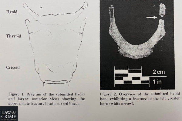 New Photo from Jeffrey Epstein's Autopsy Reveals Broken Neck Bones ...
